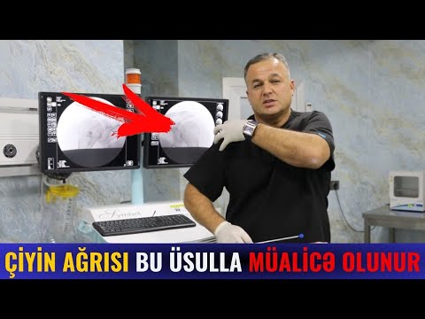 Qolunu qaldıranda ŞİDDƏTLİ AĞRI OLUR - Həkim 10 Dəqiqədə Çiyin ağrısını yox etdi!