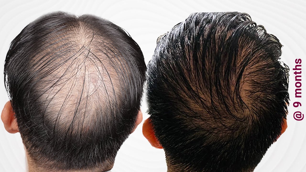 Update at 9 Months ft.Melvin Lopez – Moderator, Hair Transplant Network ...