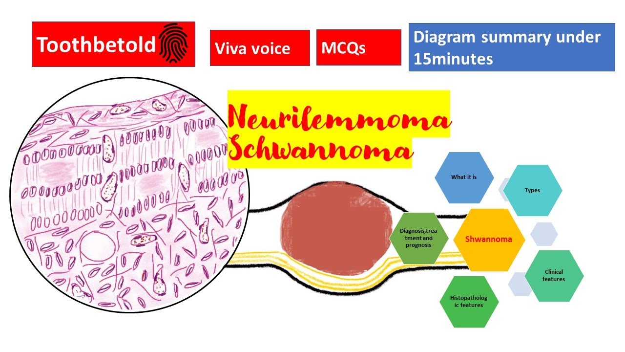Nuerilemmoma | Shwannoma | HISTOPATHOLOGY | Oral pathology | Benign ...