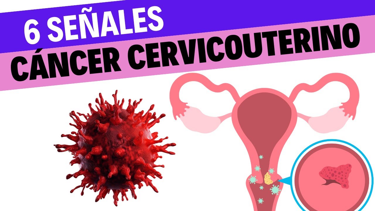 6 señales de que tendrás cáncer cervicouterino - YouTube