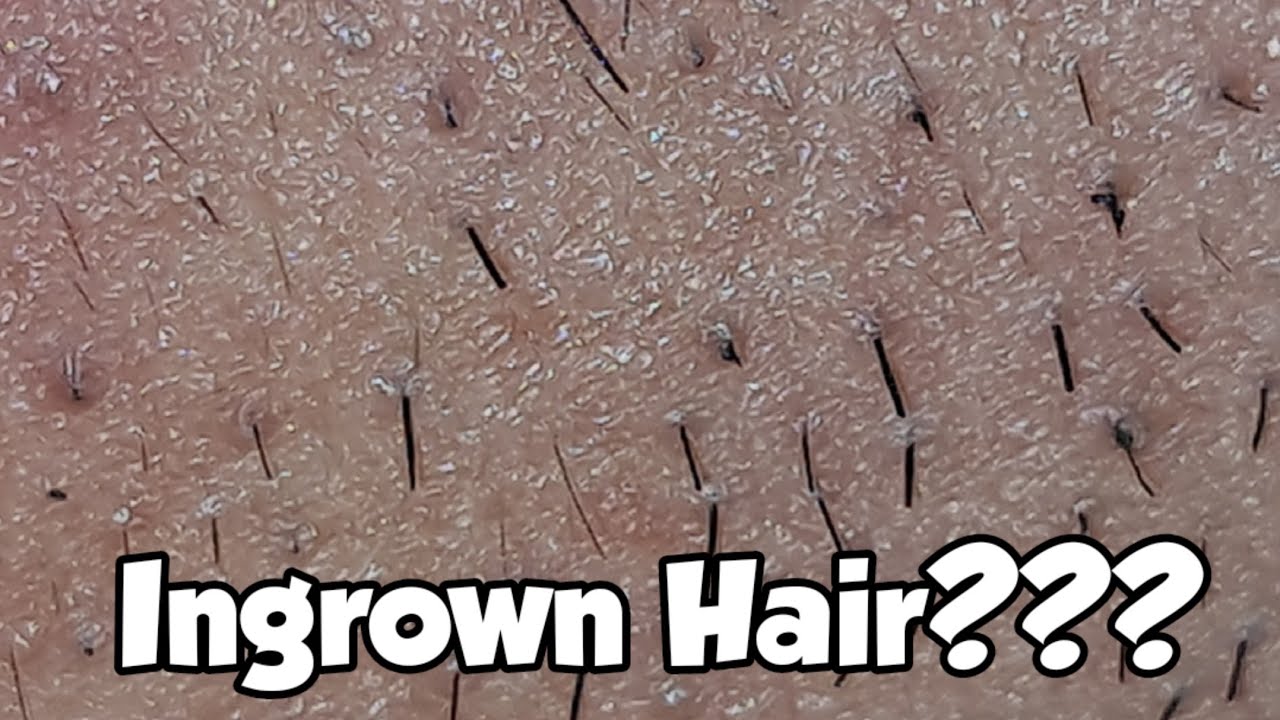 Hair Extraction X Ingrown Hair |facial Hair| - YouTube