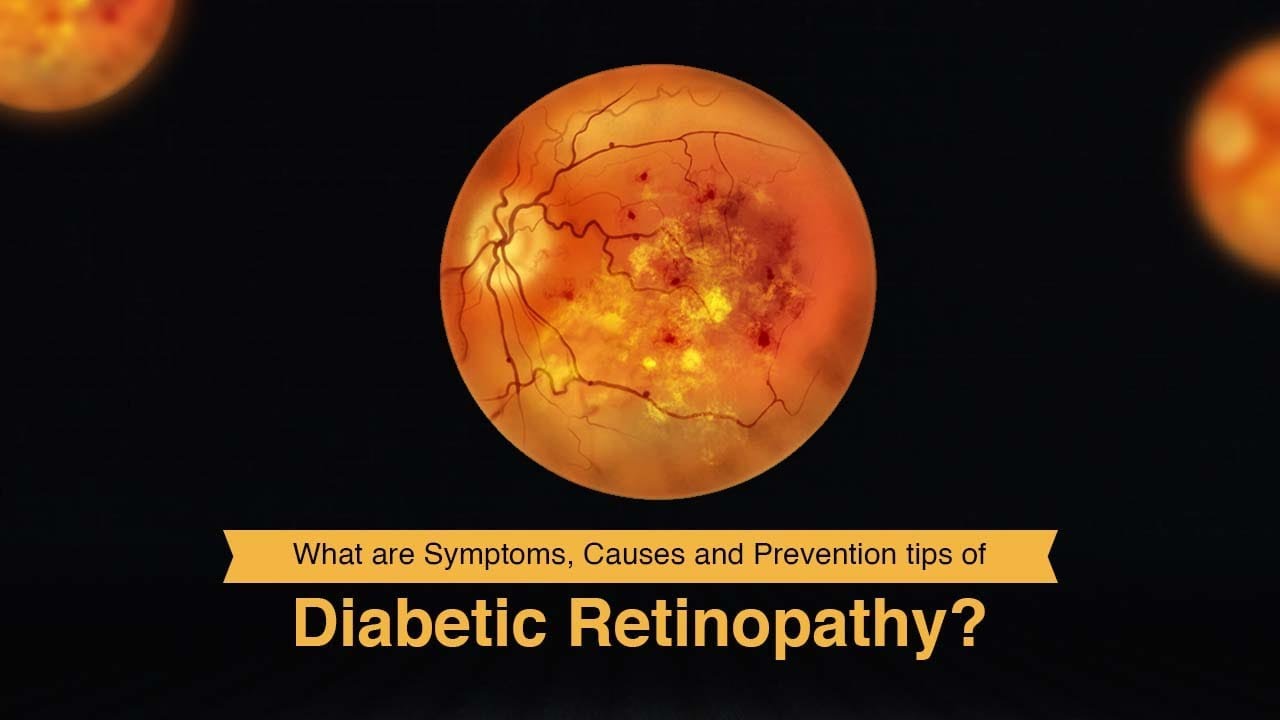 What are Symptoms, Causes and Prevention tips of Diabetic Retinopathy ...