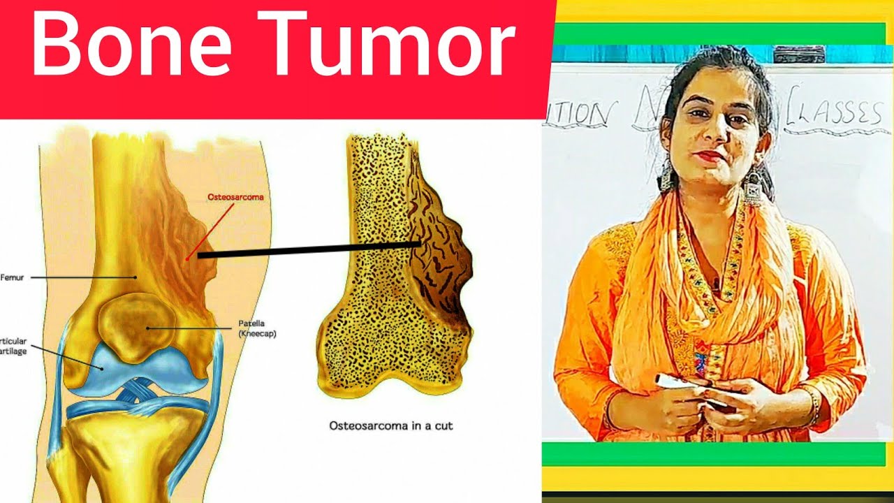 Bone Tumor : Causes, Symptom, Treatment, Diagnosis, Medical, Surgical ...