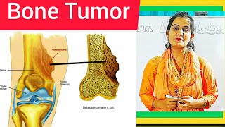 Bone Tumor : Causes Symptom Treatment Diagnosis Medical... | Doovi