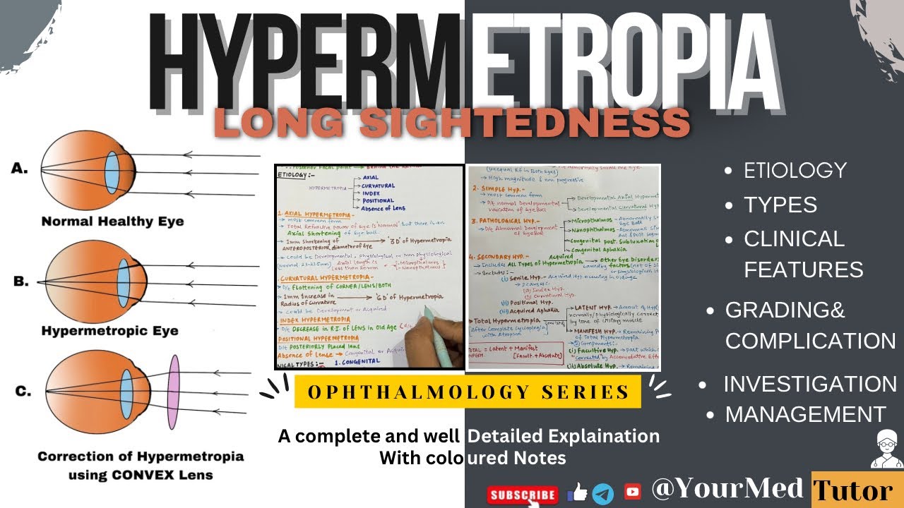 Hypermetropia | Long Sightedness | Development of Hypermetropia ...