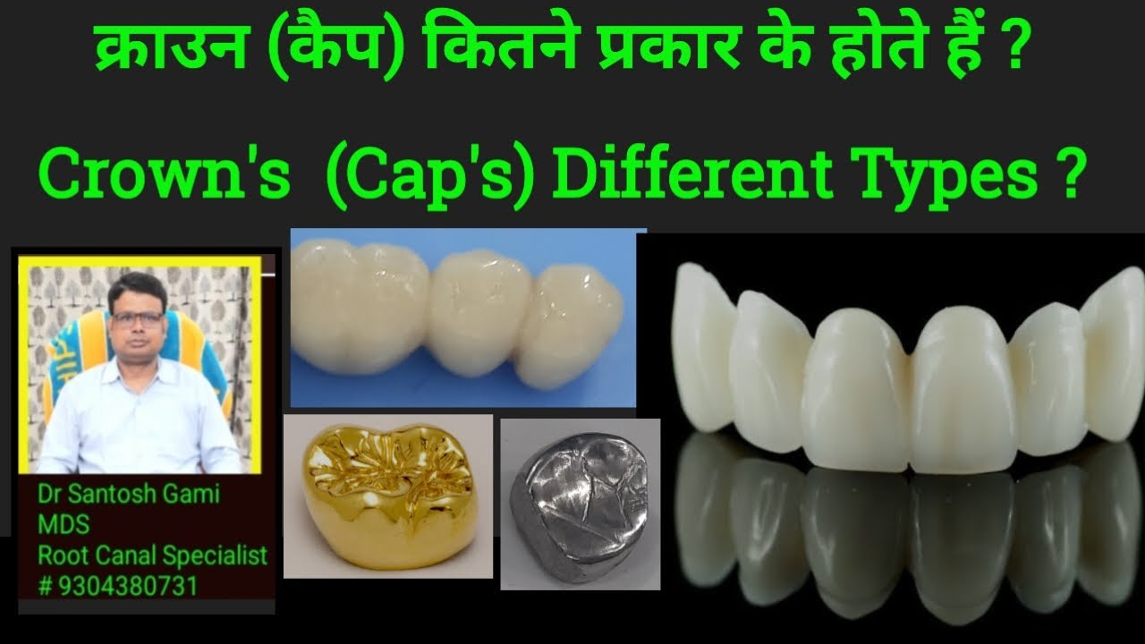 क्राउन (कैप) कितने प्रकार के होते हैं ????? Crown's (Cap's ) Different ...