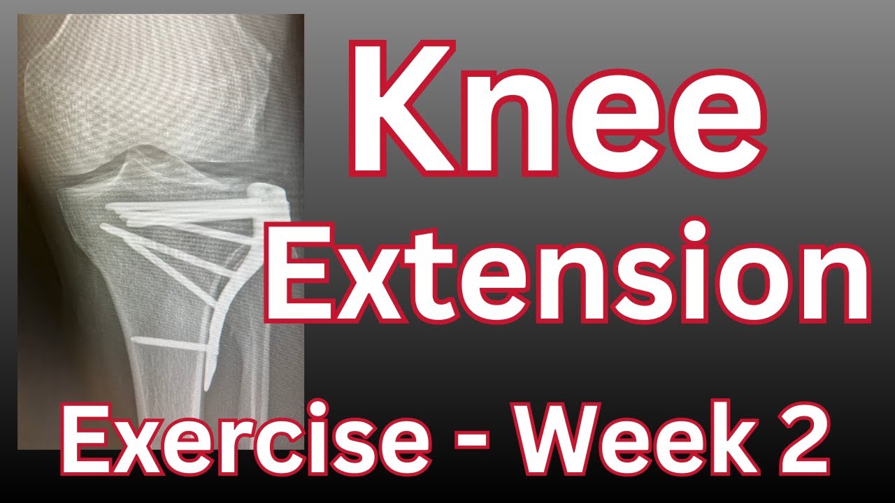Tibial Plateau Fracture - Best Knee Extension Exercise EVER - YouTube