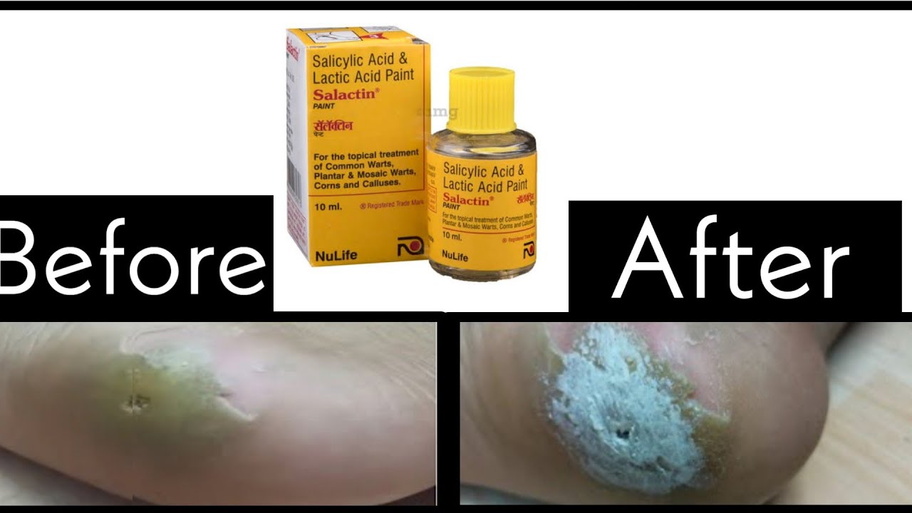 How To Apply Salactin Acid Paint To Corn, Cullus - YouTube