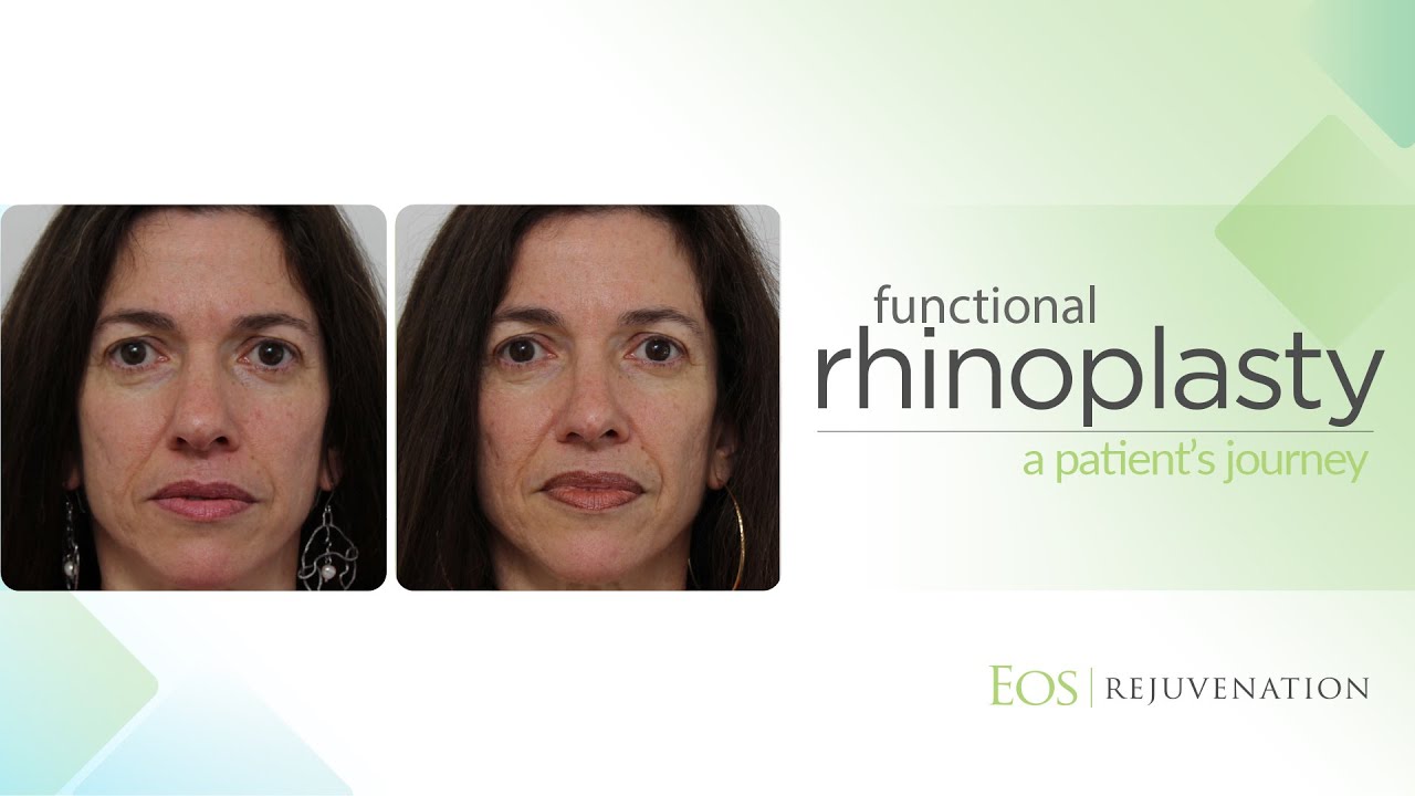 Functional Rhinoplasty at Eos Rejuvenation with Dr. Nima Shemirani ...