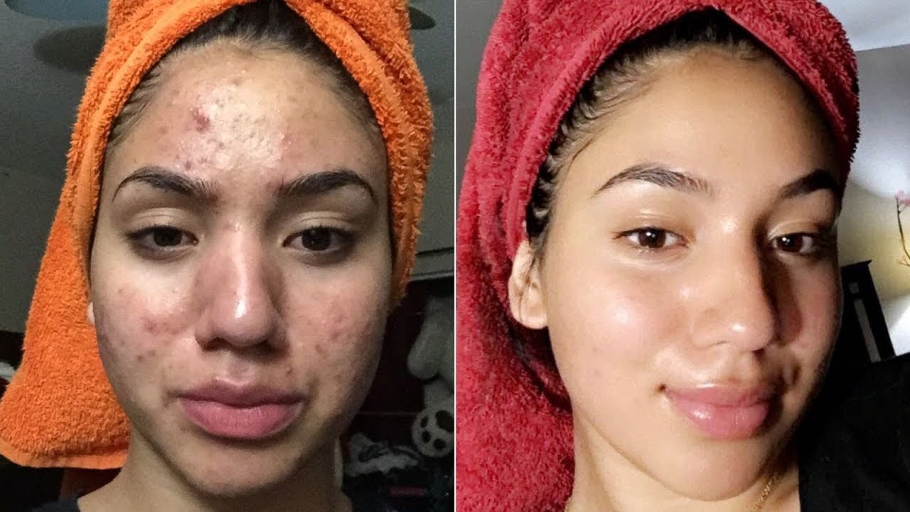 Adeus Acne - Como Acabar Com a Acne no Rosto em Uma Semana 2020 - YouTube