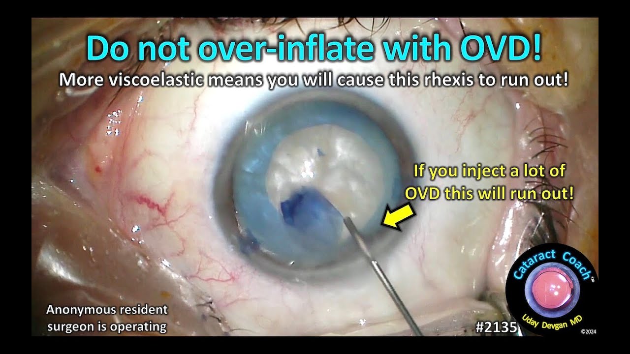 CataractCoach™ 2135: do not over inflate with OVD viscoelastic - YouTube