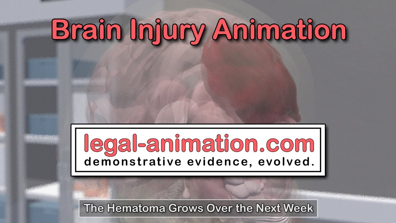 Brain Injury and Brain Surgery Animation. Legal Animation made for Mike ...