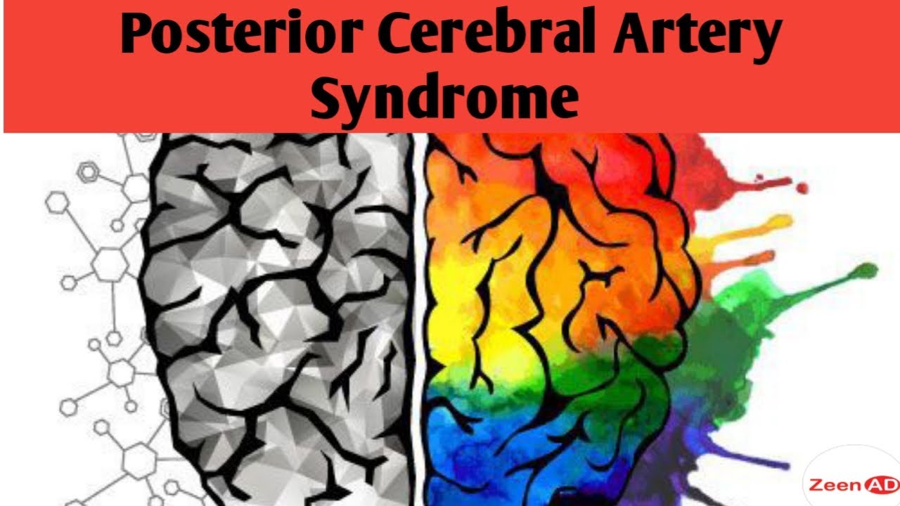 Posterior Cerebral Artery Syndrome||Posterior Cerebral Artery Stroke ...