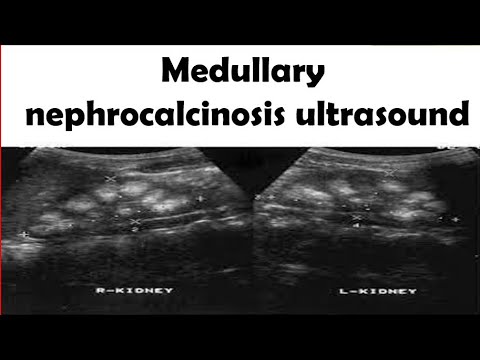 Medullary nephrocalcinosis Ultrasound - YouTube