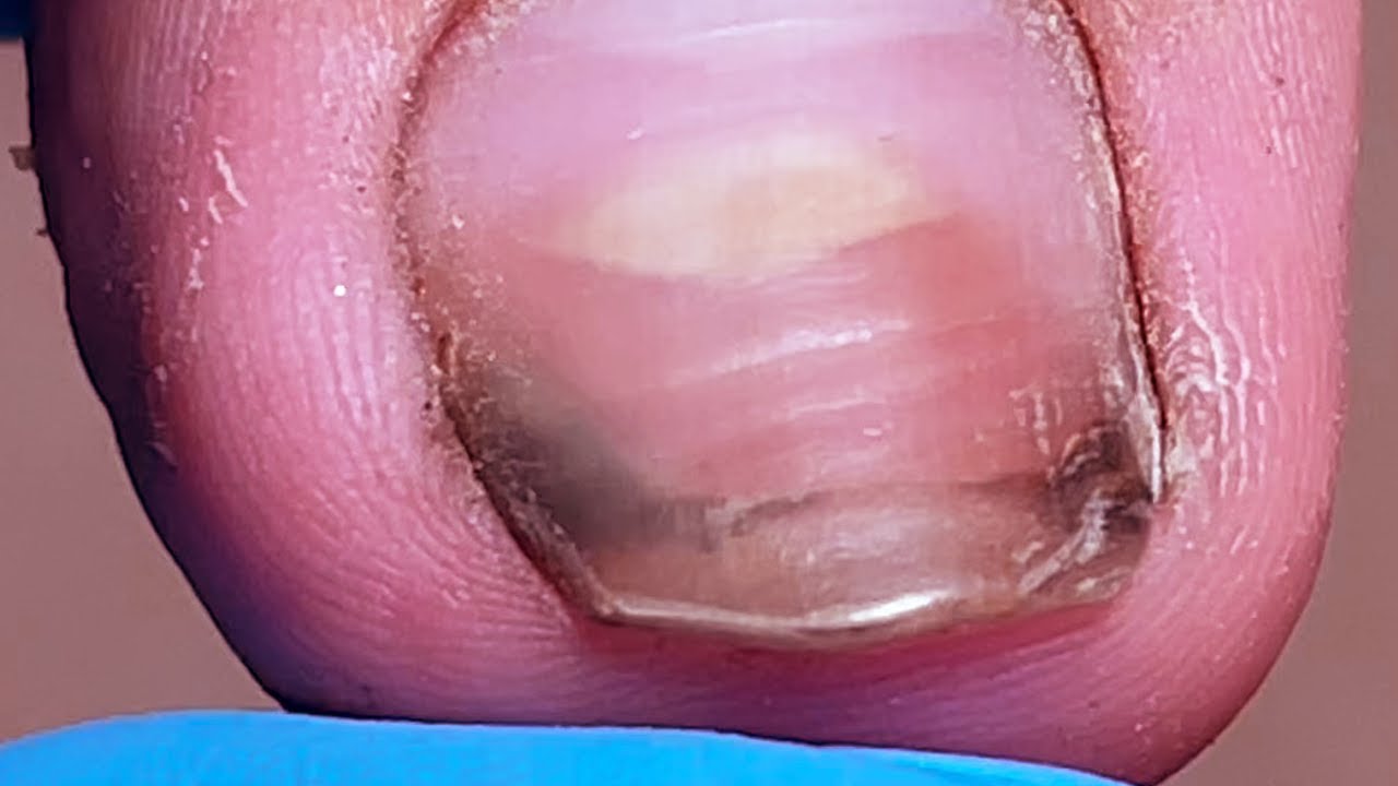 Dirt-filled toes, redness and swelling from paronychia - YouTube