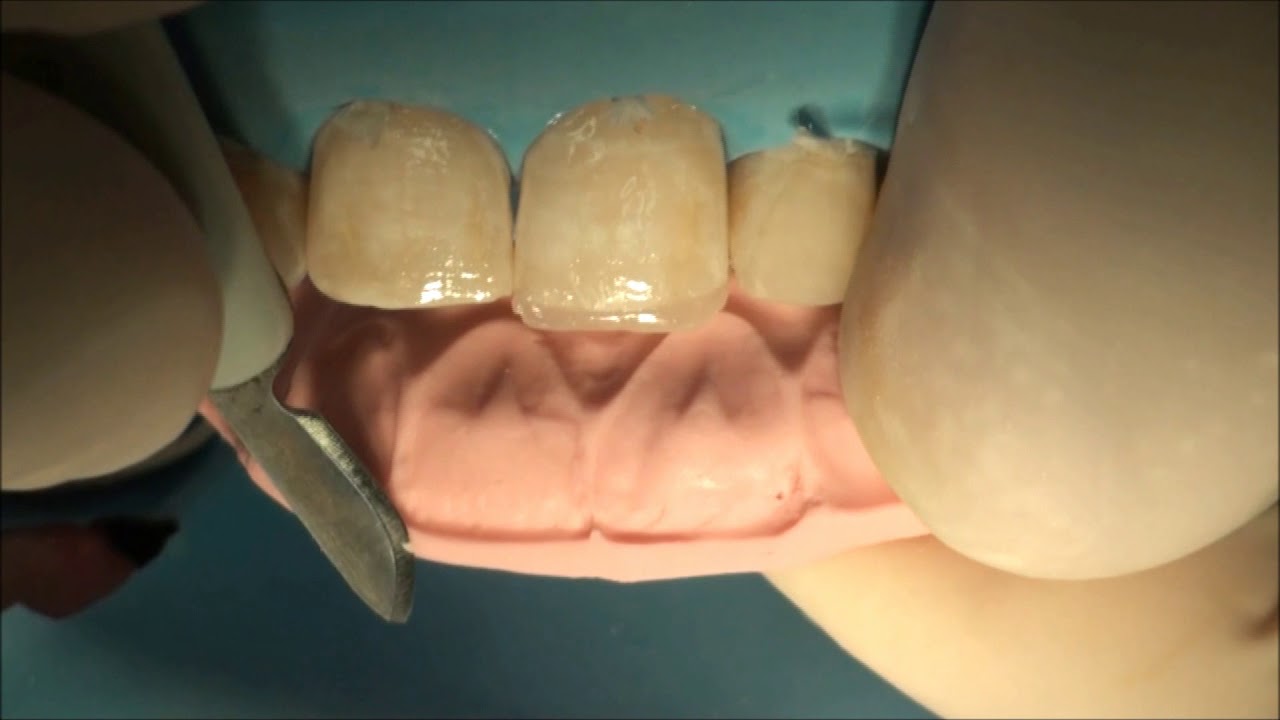 3 INSPIRO Veneers Buildup Dr Didier Dietschi - YouTube