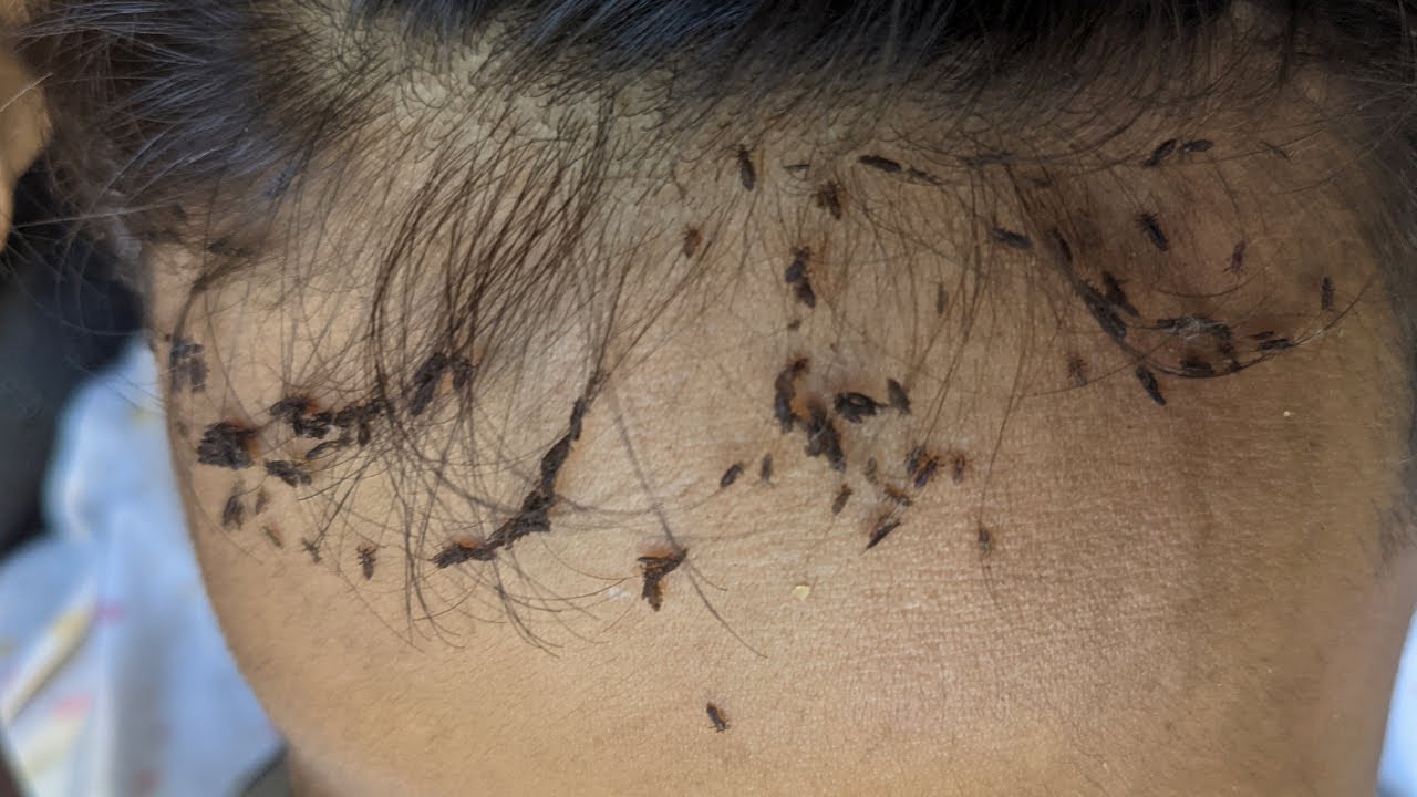 Pick out hundred lice from long hair - Take out a lot of lice out of ...