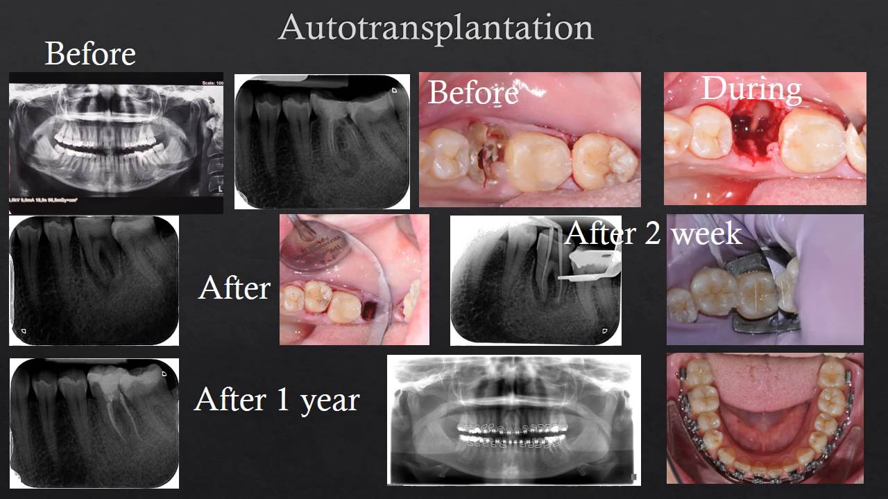 Autotransplantation of wisdom tooth - YouTube