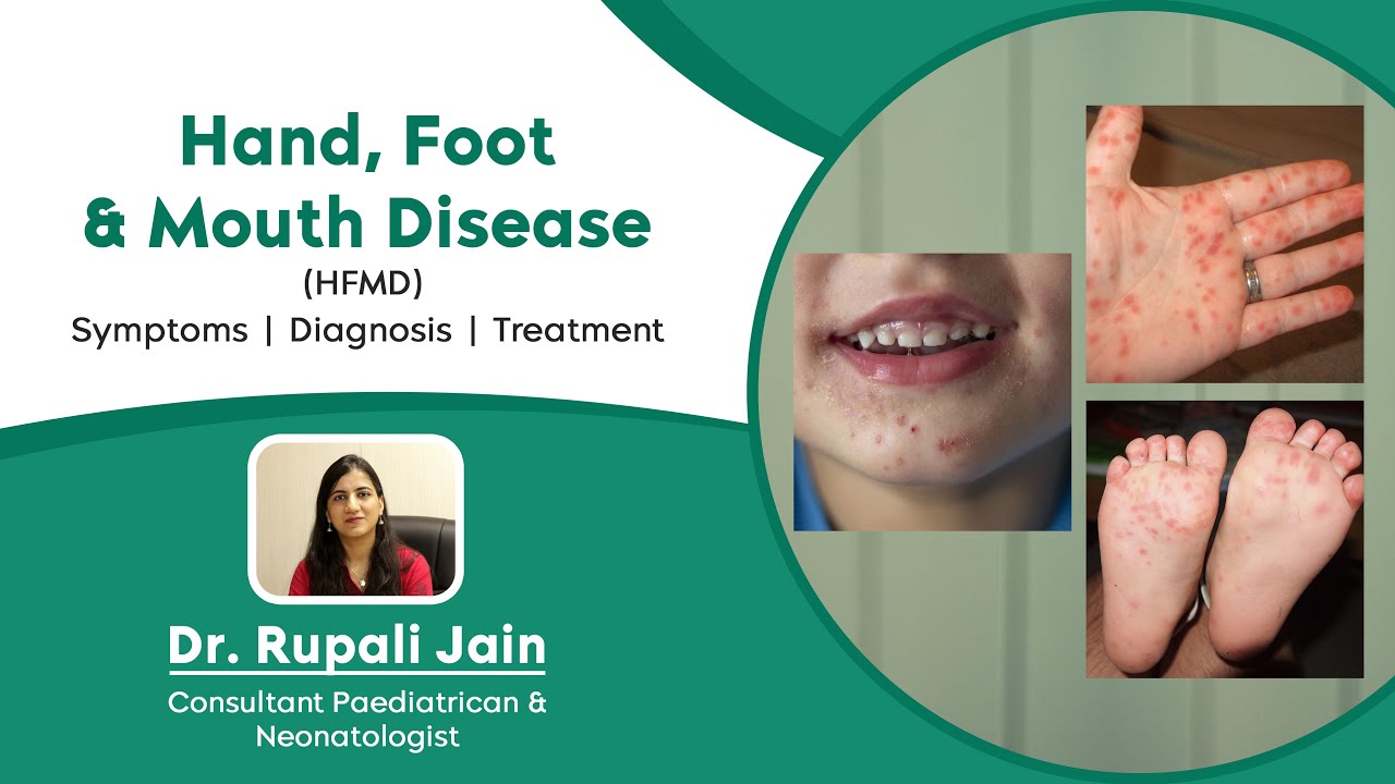 बच्चों में हाथ, पैर और मुँह का रोग | HAND FOOT MOUTH DISEASE (HFMD) in ...