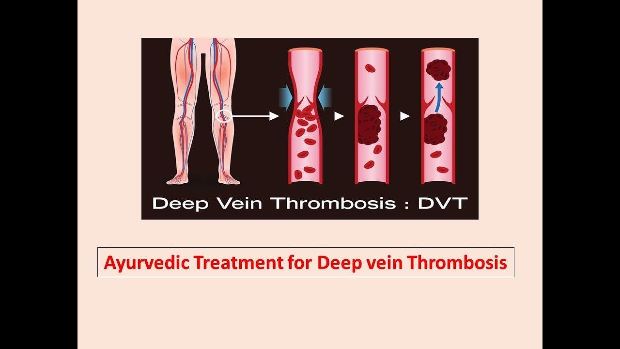 Deep Vein Thrombosis l DVT l Ayurvedic Treatment for DVT - YouTube
