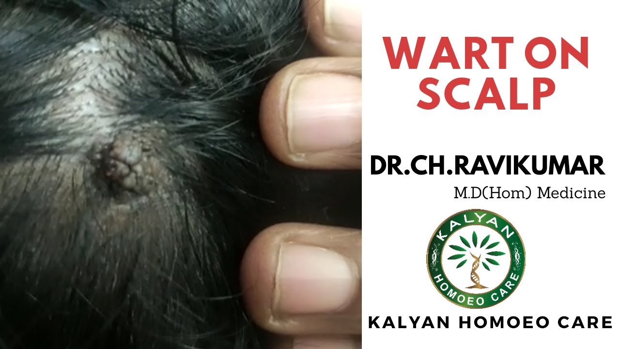 Wart On Scalp Treatment&Medicine In Homeopathy|Dr.Ch.Ravikumar M.D(Hom ...
