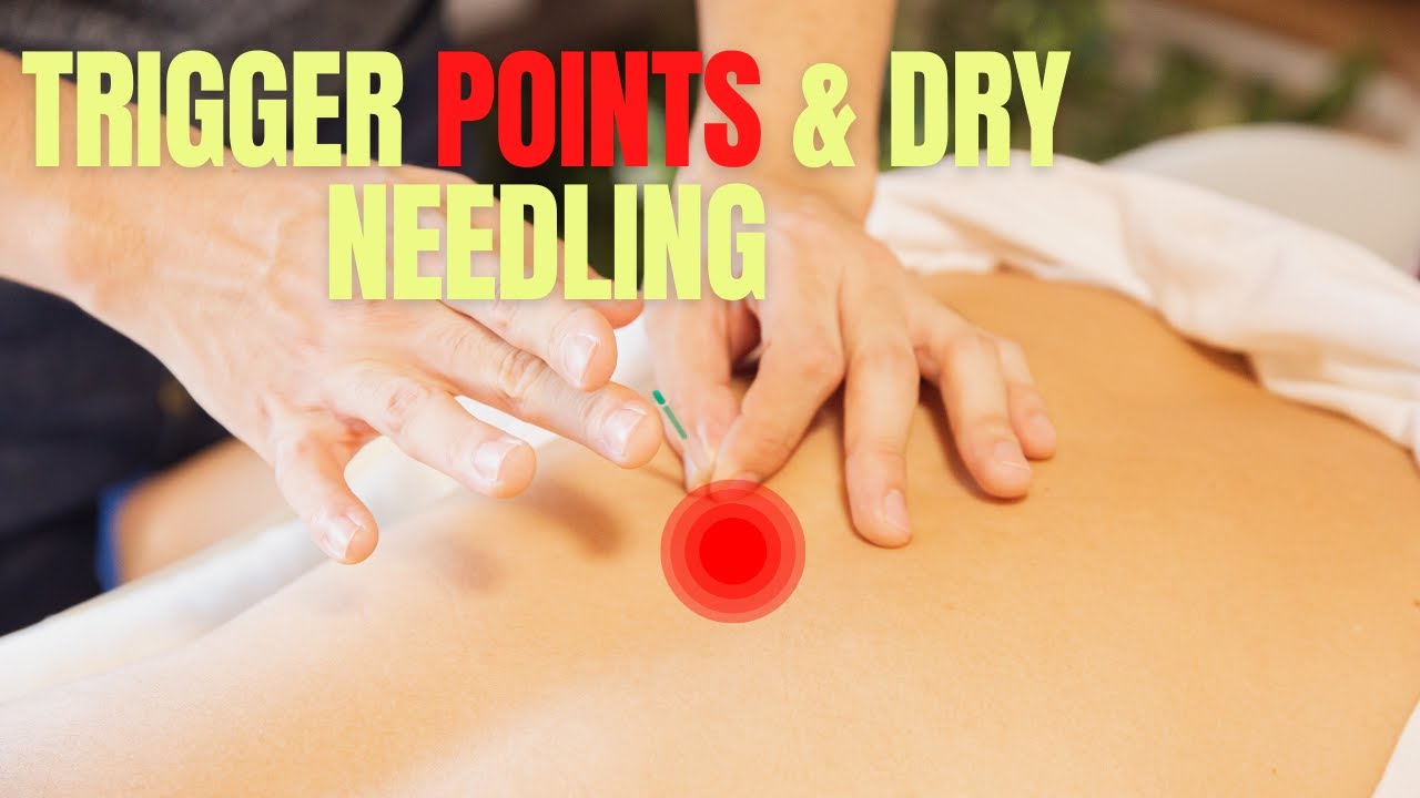 Trigger Points & Dry Needling - YouTube
