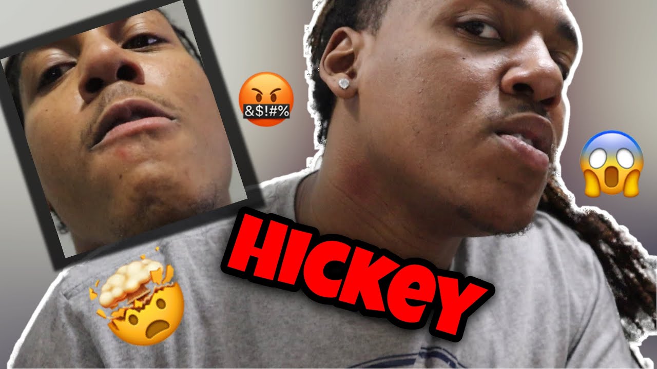 Hickey Prank Gone Wrong Youtube
