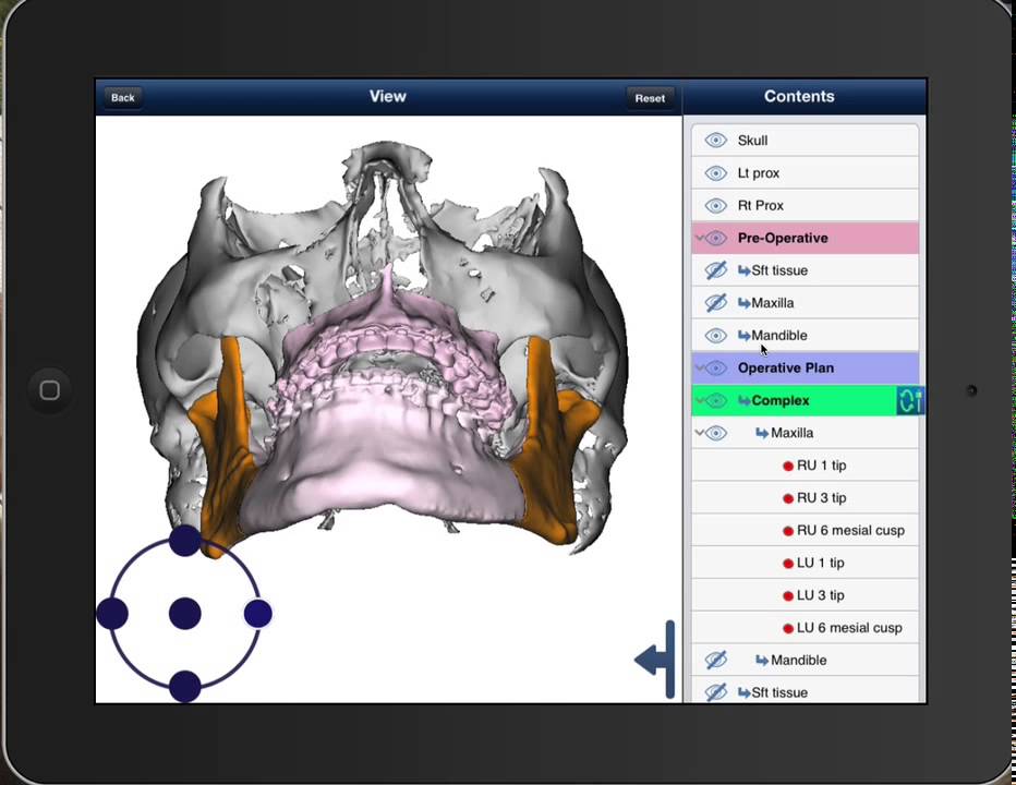 MedCAD Surgical Planning - YouTube