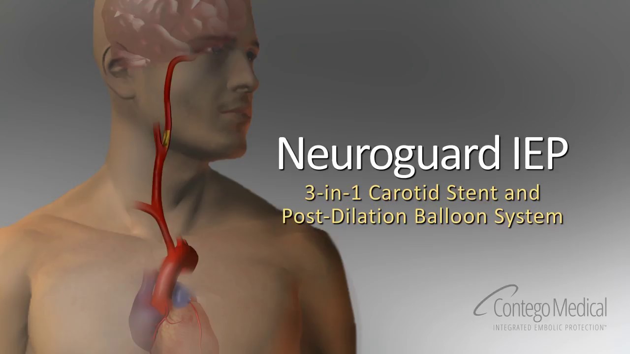 Кедев ја изврши првата имплантација на системот Neuroguard IEP за ...