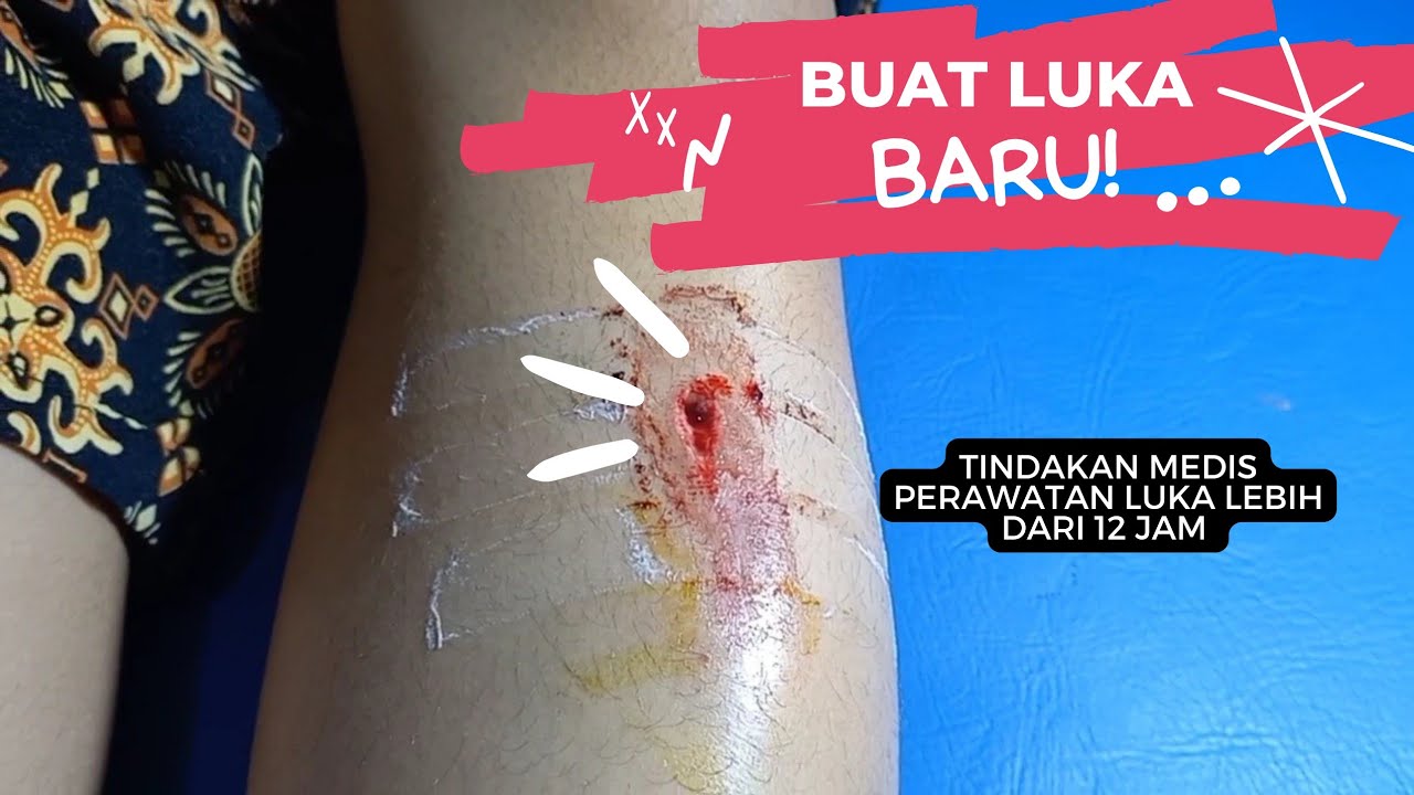 Tindakan Medis - Perawatan Luka Lebih dari 12 Jam yang Masih Belum ...