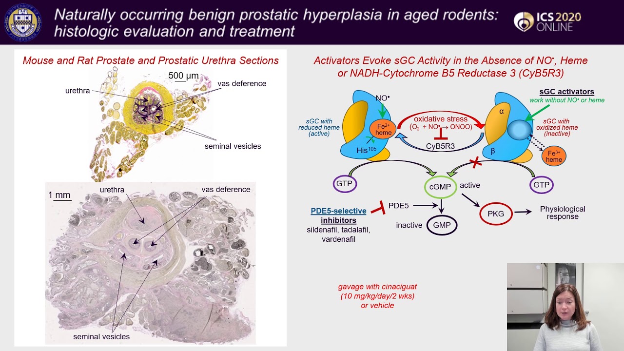 Benign Prostatic Hypertrophy Histology