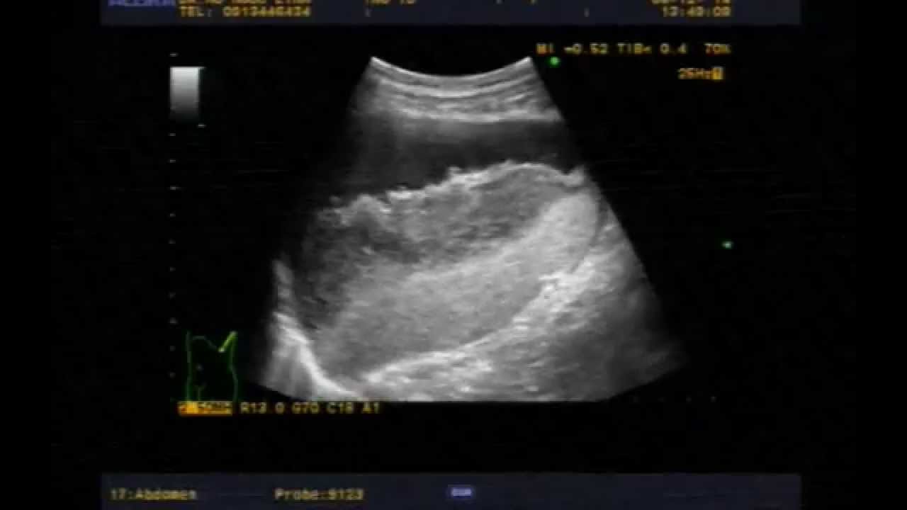 Subcapsular splenic hematoma - YouTube