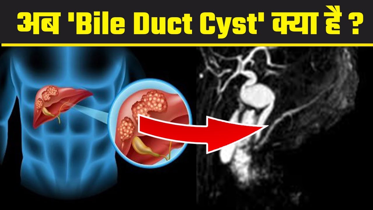 Bile Duct Cyst Kya Hai | Bile Duct Cyst Symptoms In Hindi | Bile Duct ...