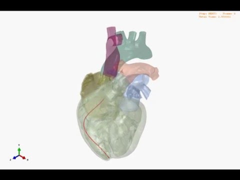 Simulation of Pacemaker lead in Living Heart Model - YouTube