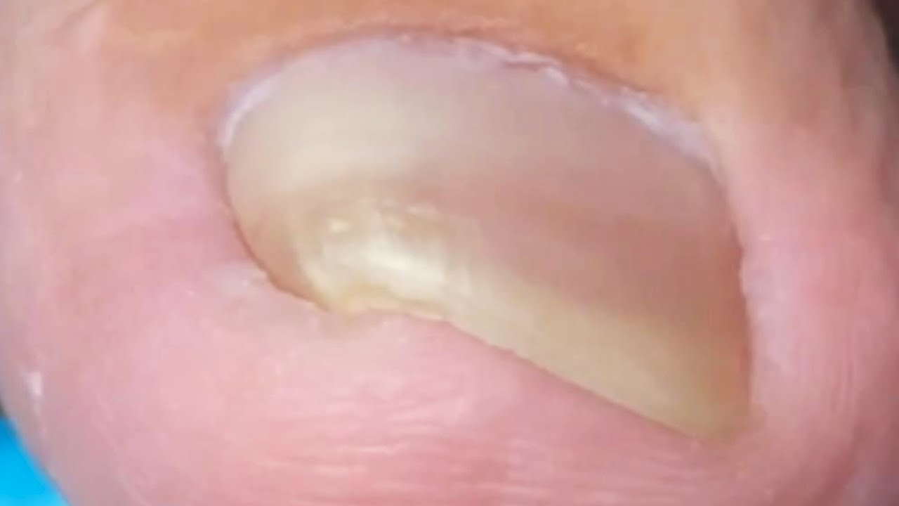 Curly onychomycosis, cut off the ingrown toenails! - YouTube