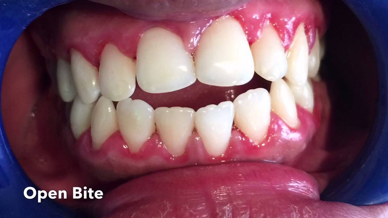 Open bite - YouTube
