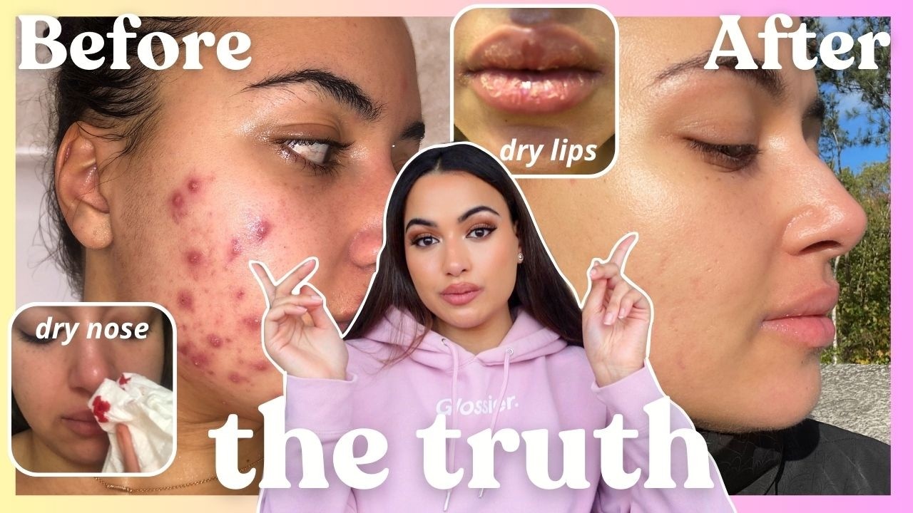 THE ULTIMATE GUIDE TO ACCUTANE FOR ACNE: Everything You Need to Know ...