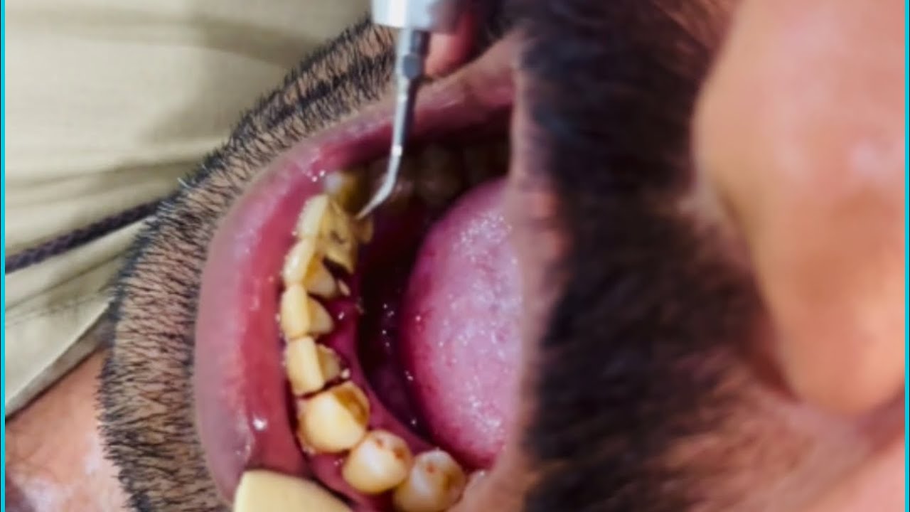 Teeth cleaning ? Heavy calculus plaque | tartar removal | teeth ...