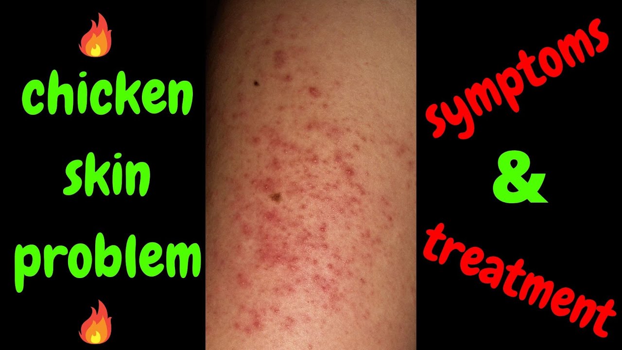 CHICKEN SKIN PROBLEM OR KERATOSIS PILARIS | symptoms & treatment | चिकन ...
