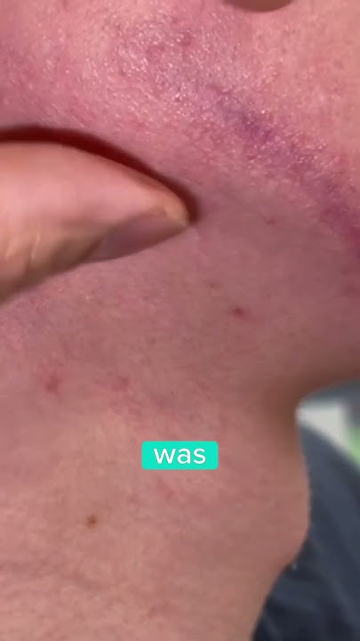Scar Revision On Face Dr Tanveer Janjua New Jersey Youtube