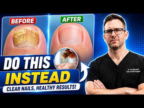 Is Your Toenail Fungus Getting Worse? Try This Instead