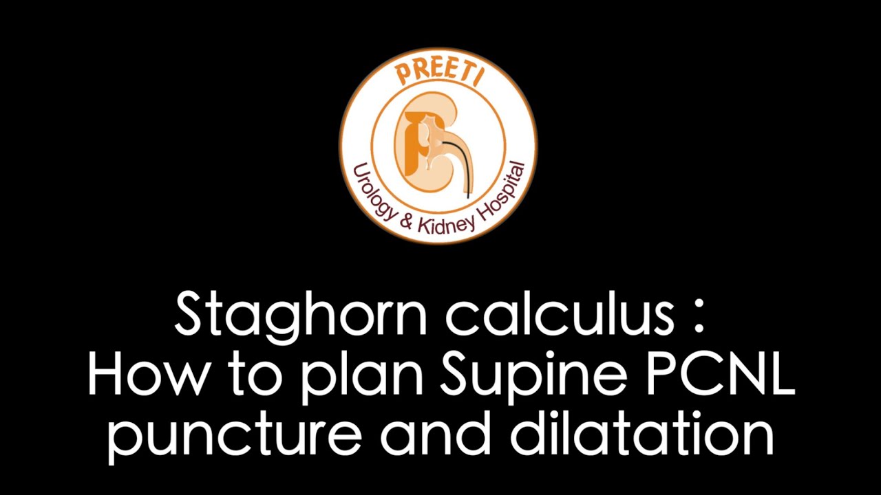 Staghorn calculus : How to plan Supine PCNL puncture and dilatation ...
