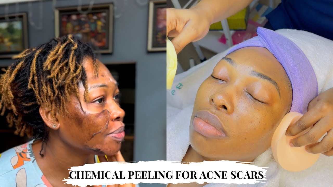 MY DEEP CHEMICAL PEEL EXPERIENCE: FULL PROCEDURE - YouTube