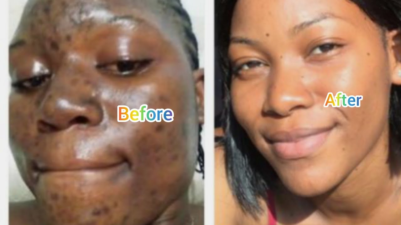 UTAKOMESHA MADOA CHUNUSI USONI UKIZINGATIA HAYA - YouTube