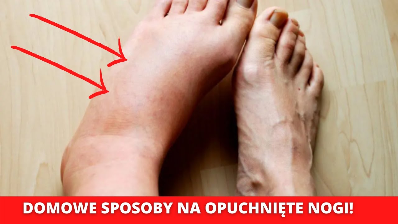 OPUCHNIĘTE Nogi I Stopy – Domowe Sposoby – Skuteczne I Sprawdzone ...