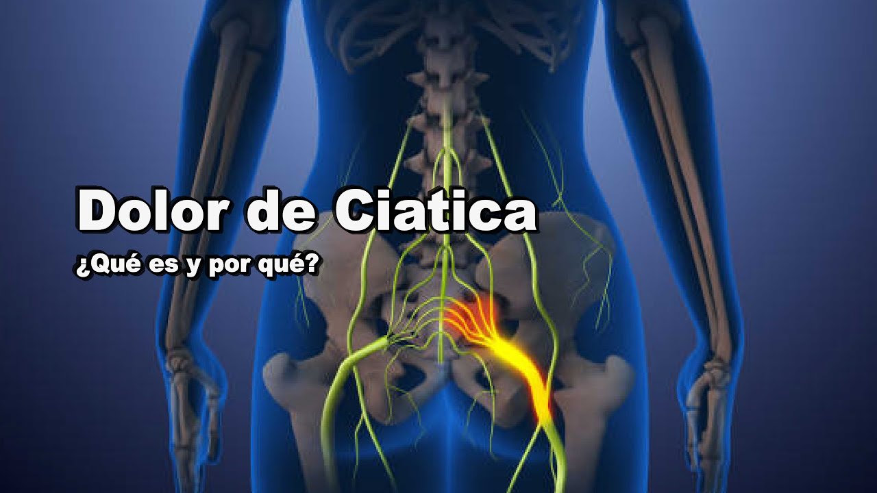 Dolor de Ciatica ¿Qué es y por qué? | Salud para todos. - YouTube