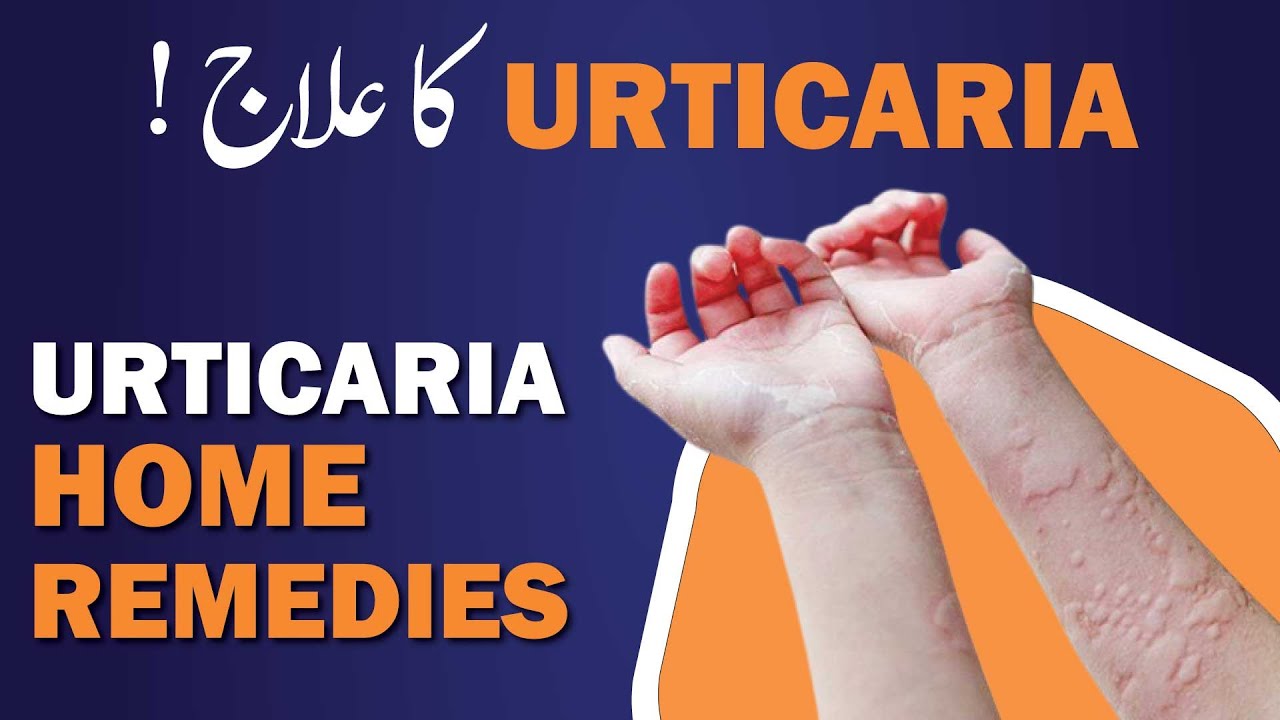 Top 3 Natural Remedies To Get RID Of URTICARIA | Skin Allergy (Chapaki ...