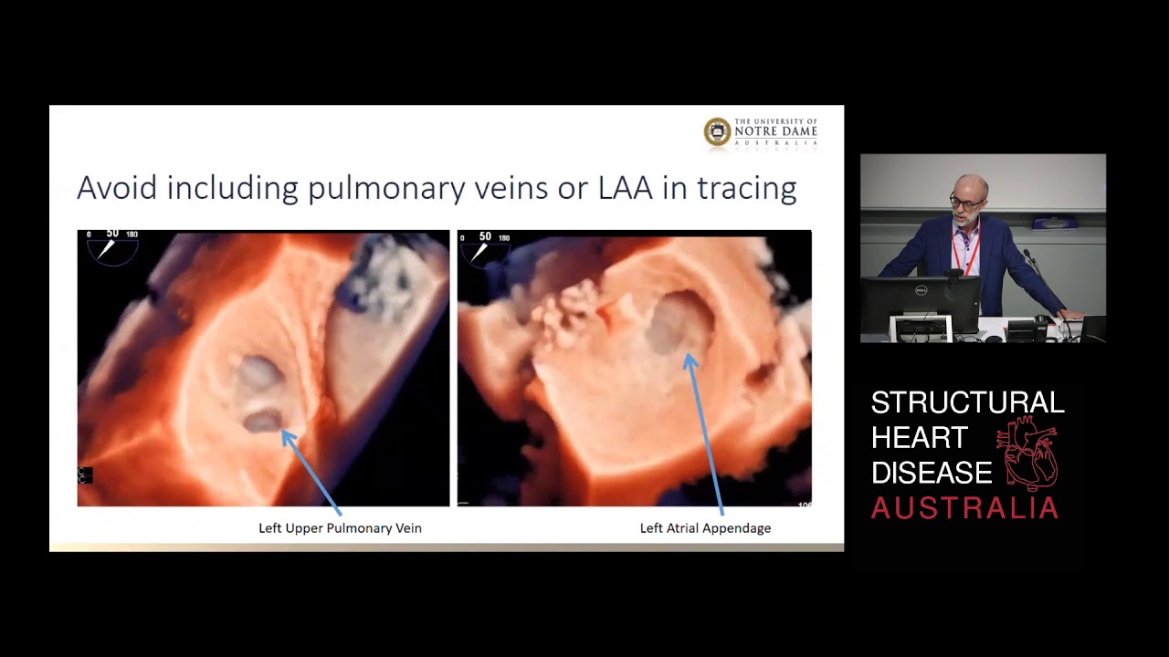 Measuring Left Atrial Volume is Important in Predicting Outcome - Prof ...