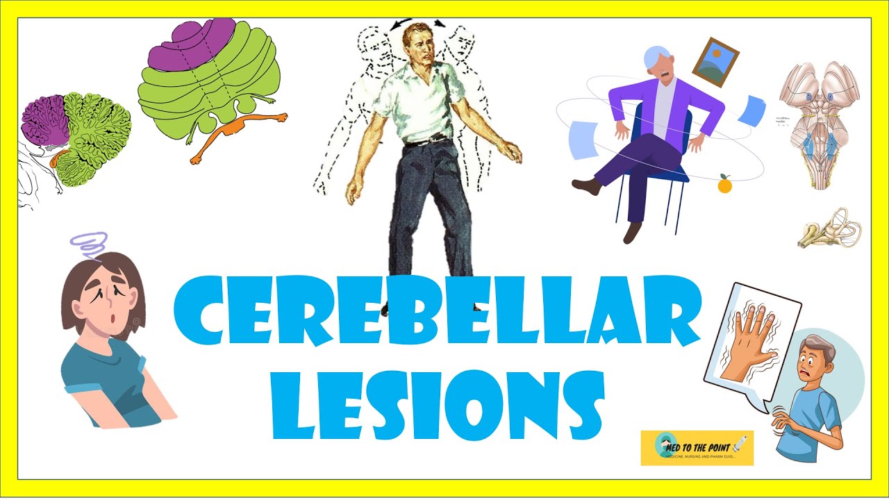 Cerebellar lesions:-examination, signs, lesions and ataxic gait ,heel ...