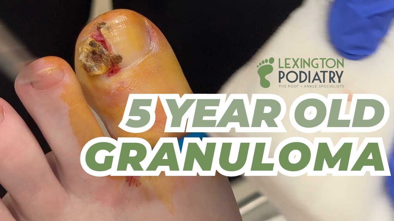 Wart or Ingrown? | Nail Removal Revealed - YouTube